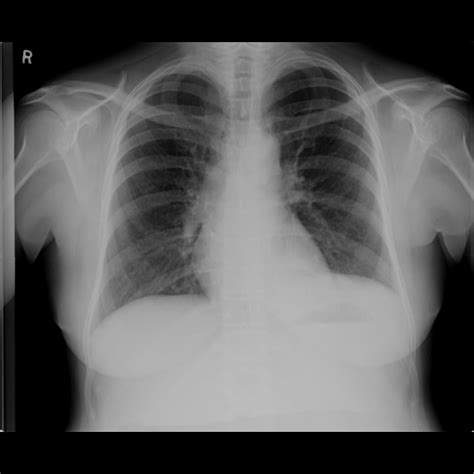 Subpulmonic Pleural Effusion The Left Dome Of Diaphragm Is Higher