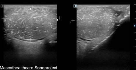 Testicular Microlithiasis Mascot Healthcare Sonoproject