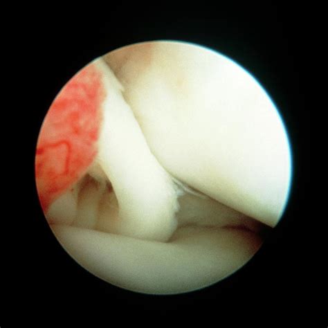 Torn Knee Meniscus 2 Photograph By Cnri Science Photo Library Pixels