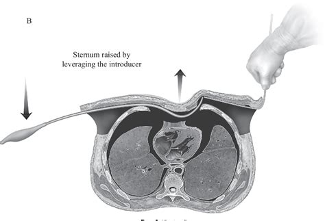 Figure 1 From The Minimally Invasive Repair Of Pectus Excavatum