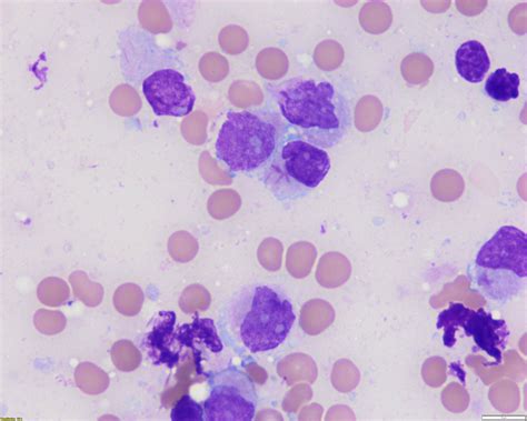 Pathology Outlines Apl With Pmlrara