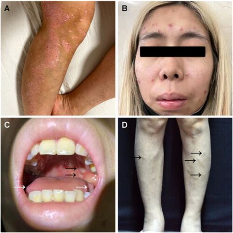 Full Article Behcets Like Disease Induced By Secukinumab In A Patient