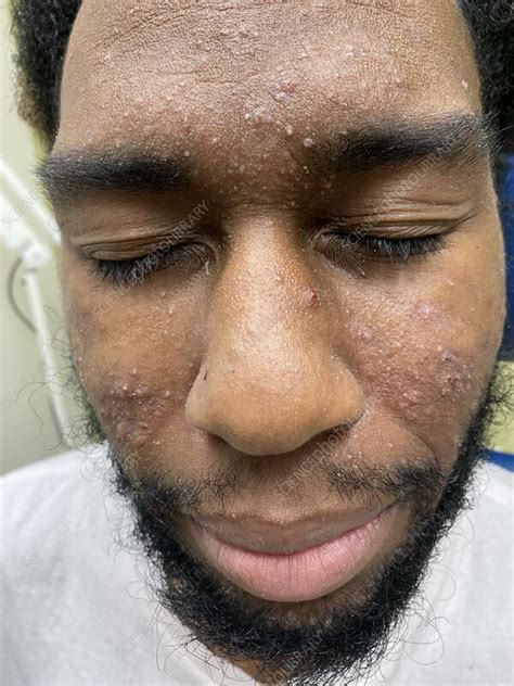 Dissecting Cellulitis Stock Image C060 4134 Science Photo Library