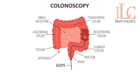 Preparing For A Colonoscopy A Guide To A Smooth Procedure