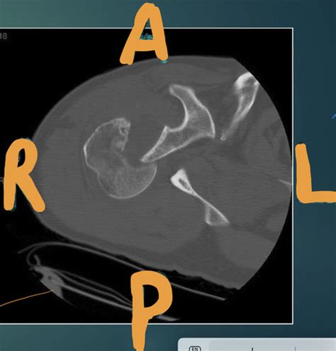 CT Scan Flashcards Quizlet