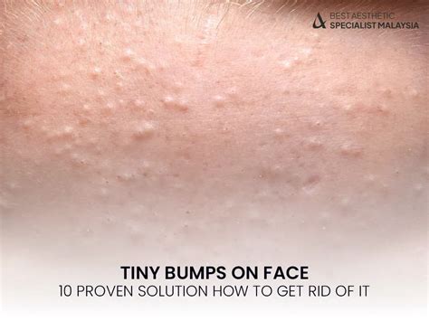 Tiny Bumps On Face 10 Proven Solutions To Get Rid Of It