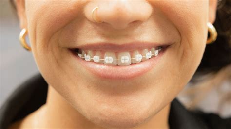 Lightforce™ Braces Northeast Orthodontics St Petersburg Seminole Fl