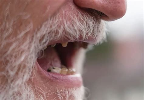 Can Bad Teeth Cause Infection In Your Body Major Types And Prevention