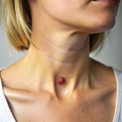 Thyroid Swelling In Neck Detailed Pictures And Symptoms Premium Ai