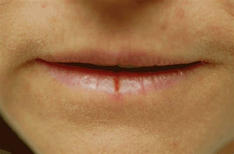 Actinic Cheilitis Pictures Treatment Symptoms Causes 2018 Updated
