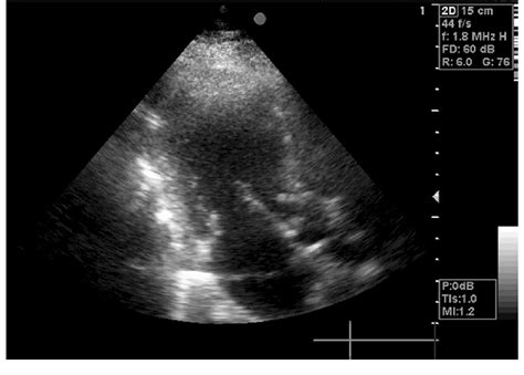 Infective Endocarditis Ie Due To Abiotrophia Defectiva Transthoracic