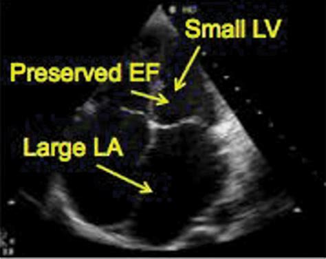 Left Ventricle Echocardiography Ef Ejection Fraction Lv Left