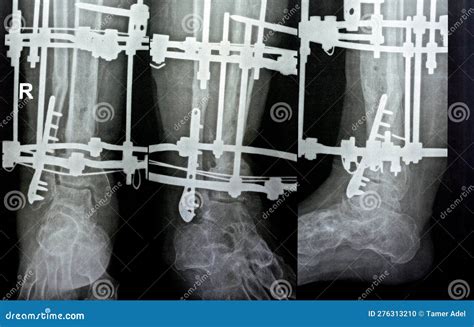 Distal Comminuted Fracture Fibula Managed By Plate And Screws Distal Tibia Managed By External