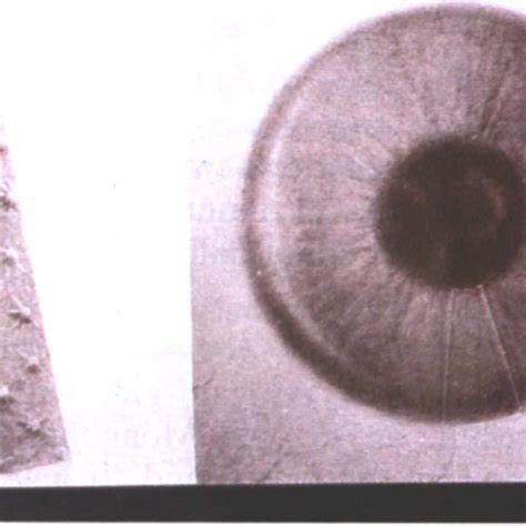 Case 3 Iris Mammillations Overlying Naevus Download Scientific Diagram