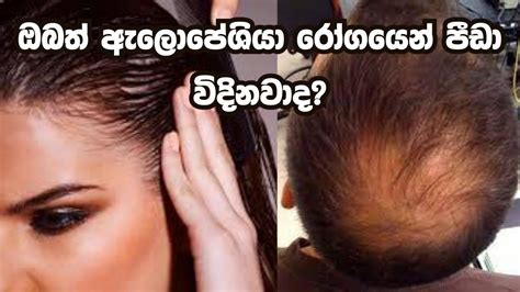 ඔබත් ඇලොපේශියා රෝගයෙන් පීඩා විදිනවාද Youtube