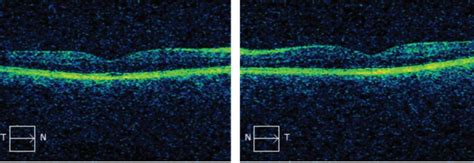 Macular Oct Imaging Is Vital In Work Up Of Cataract Surgery Patients