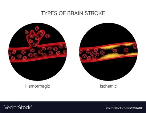 Brain Stroke Ishemic And Hemorrhagic Royalty Free Vector
