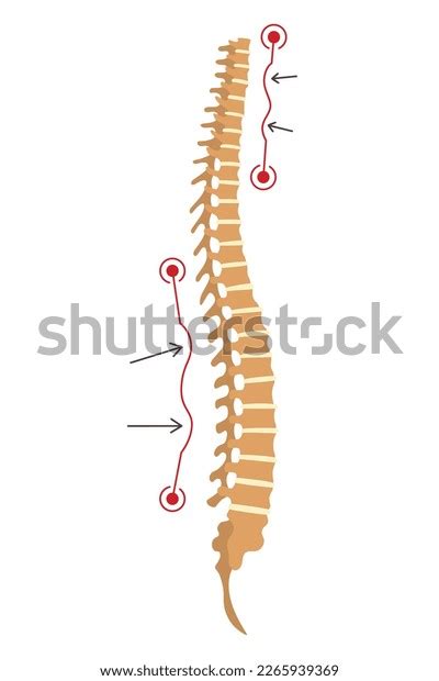 Spinal Deformity Symbol Spine Curvatures Unhealthy Stock Illustration Shutterstock