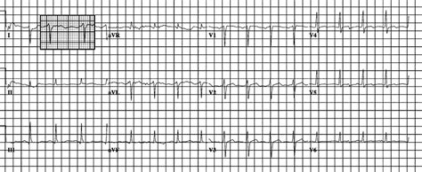 Left Posterior Fascicular Block Lpfb Ecg