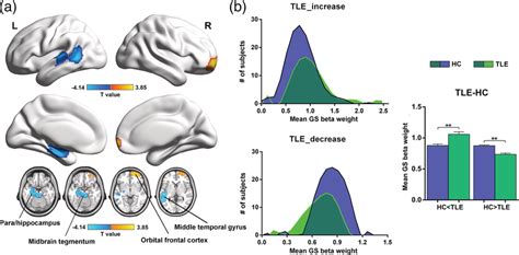 altered spatial distribution of gs beta weights in tle a voxel‐wise