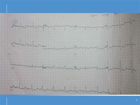 Atrial Flutter Afl Management Principals Pptx Ear Nose And
