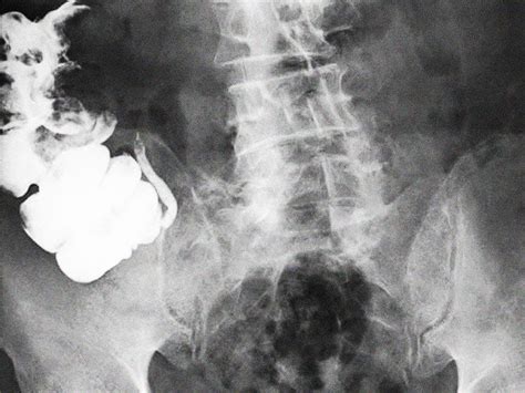 Appendicitis Signs Symptoms And Treatment