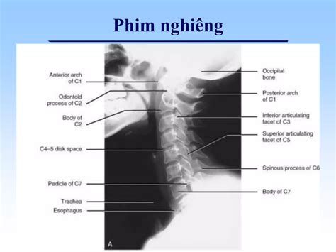 X Quang CỘt SỐngpptx