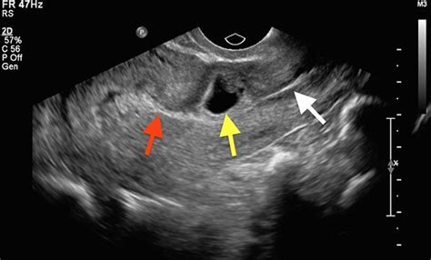 Cesarean Scar Ectopic Pregnancy Applied Radiology