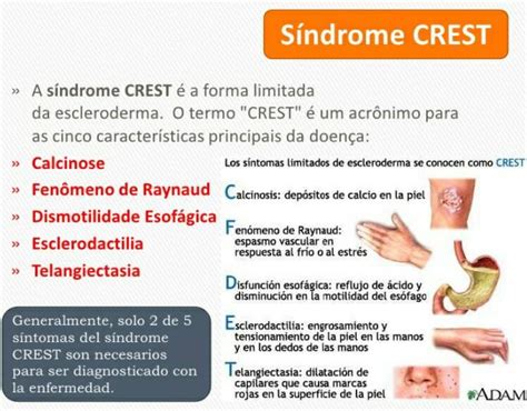 Sindrome De Crest El Sindrome De Crest Representa Una Forma Sistemica