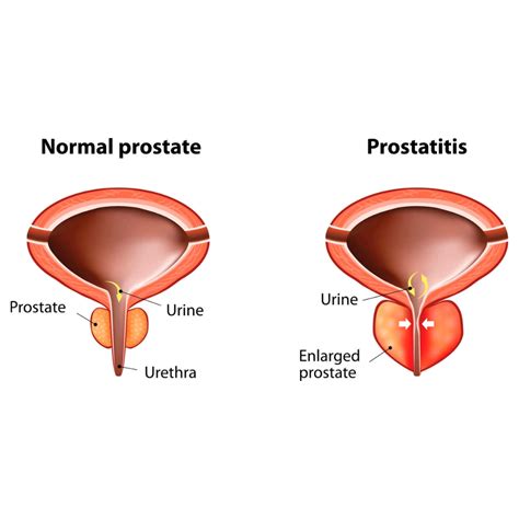 Urinary And Prostate Disorders Male Ankurhealthcare