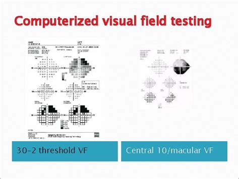 Visual Field Examinations Week Review Visual Field