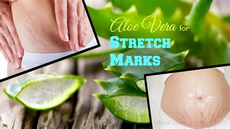 17 Useful Ways On How To Use Natural Aloe Vera For Stretch Marks