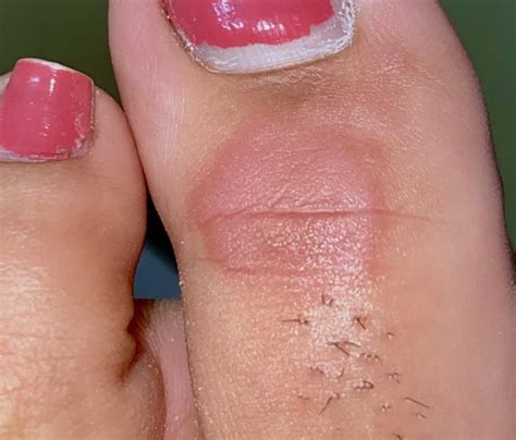 Chilblains R Raynauds