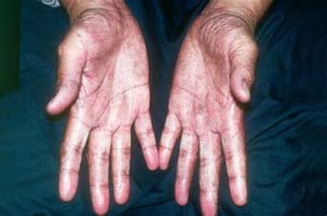 Eczema Plastic Surgery Key