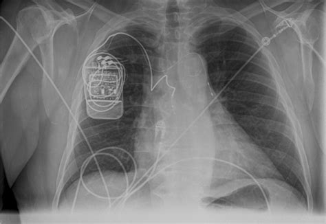 Pacemaker Device Could Improve Sleep Apnea Live Science