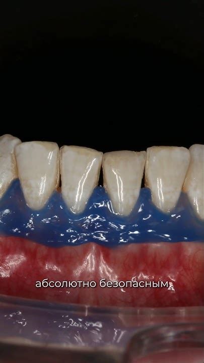 От белых пятен на зубах можно избавиться Как Youtube