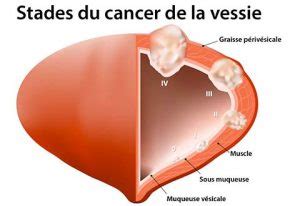 Stadification Réseau canadien des survivants du cancer
