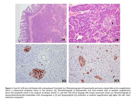 Pancreatic Heterotopia Masquerading As Malignancy A 15 Year Si