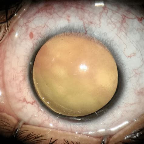 Ectropion Uvea With Fixed Dilated Pupil Download Scientific Diagram