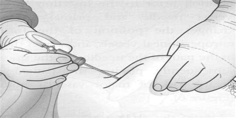 Insufflation Techniques In Gynecologic Laparoscopy Surgical