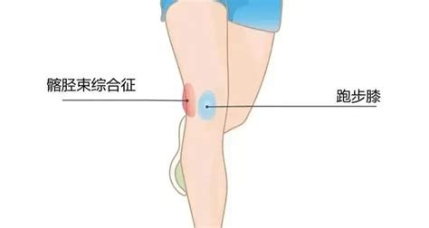 聊聊髂胫束综合征，大家常说的跑步膝 知乎