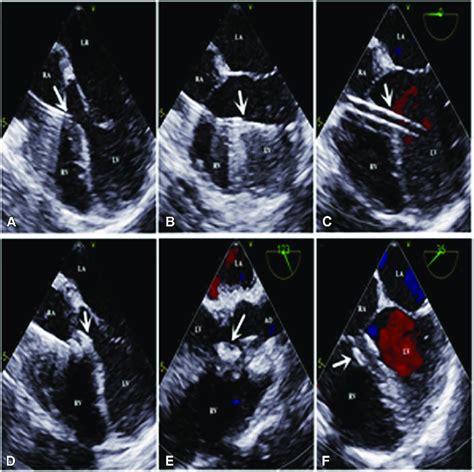 Operative Steps A Hollow Probe Arrow Passed Across The Defect B Download Scientific