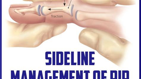 Distal Phalanx Dislocation Distal Phalanx Dislocation
