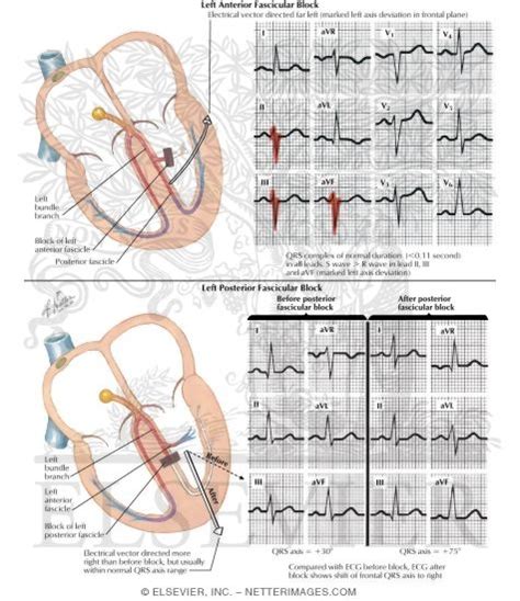 Left Anterior Fascicular Block