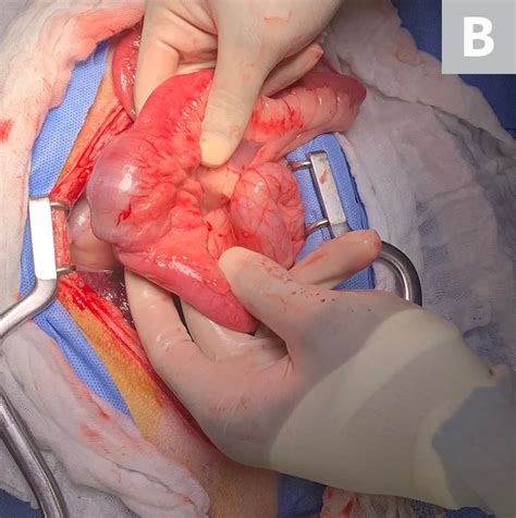 Intussusception Reduction Clinicians Brief