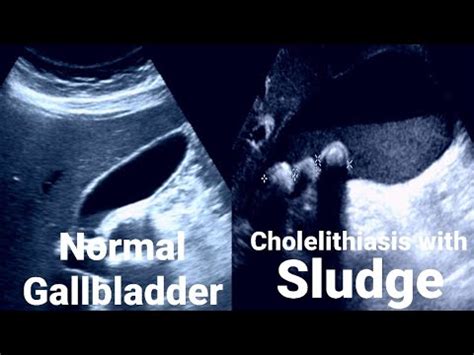 Gallbladder Ultrasound Normal Vs Abnormal Image Appearances Comparison