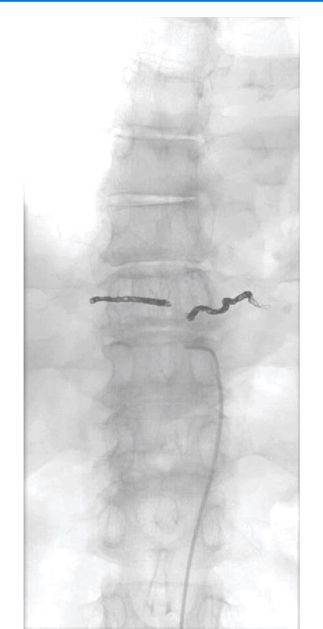 Figure 1 From Atypical Vertebral Hemangioma An Aggressive Form Of A