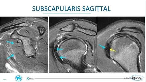Subscapularis Muscle Tear