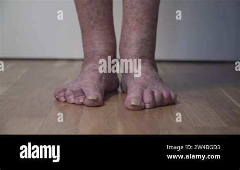 Sore Toenails Closeup Unrecognizable Person Old Man A Poor Womans