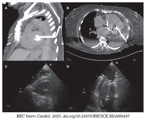Percutaneous Closure Of Left Ventricular Puncture After Thoracentesis